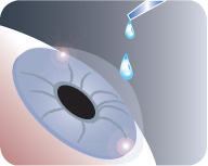 PRK Laser Eye Surgery