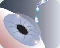 LASIK Laser Eye Surgery | optilase.co.uk