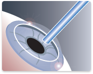 PRK Laser Eye Surgery Laser Eye Surgey